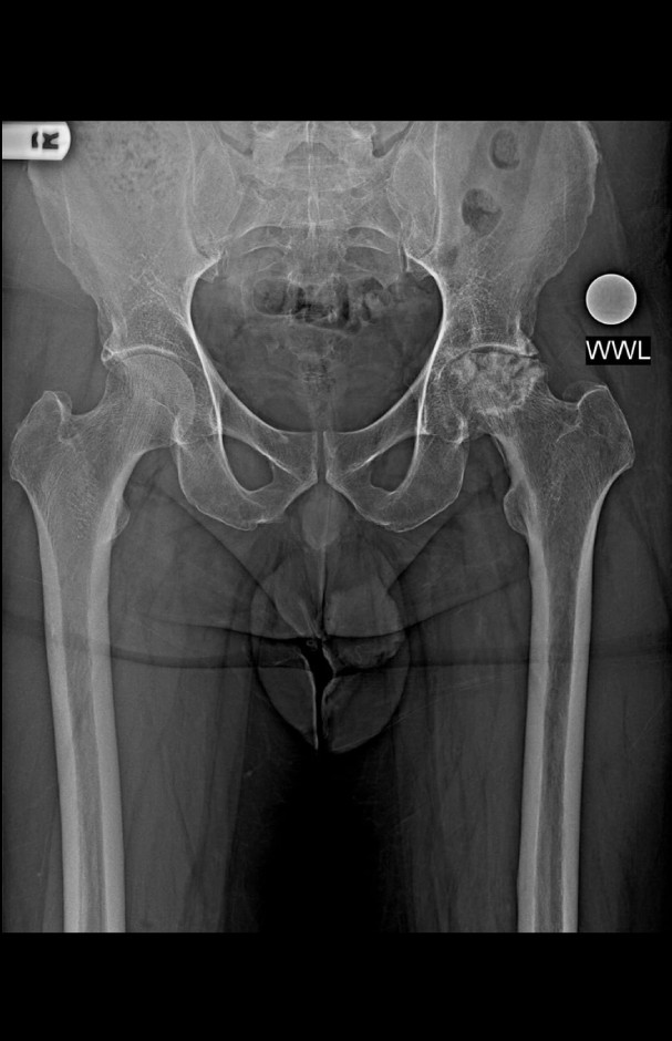 Direct Anterior Approach (DAA) Hip Replacement in Electronic City